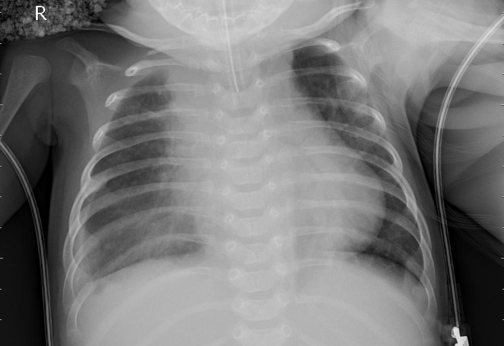 brain tumor Object Detection Dataset by binary obj detection brain and pneumonia