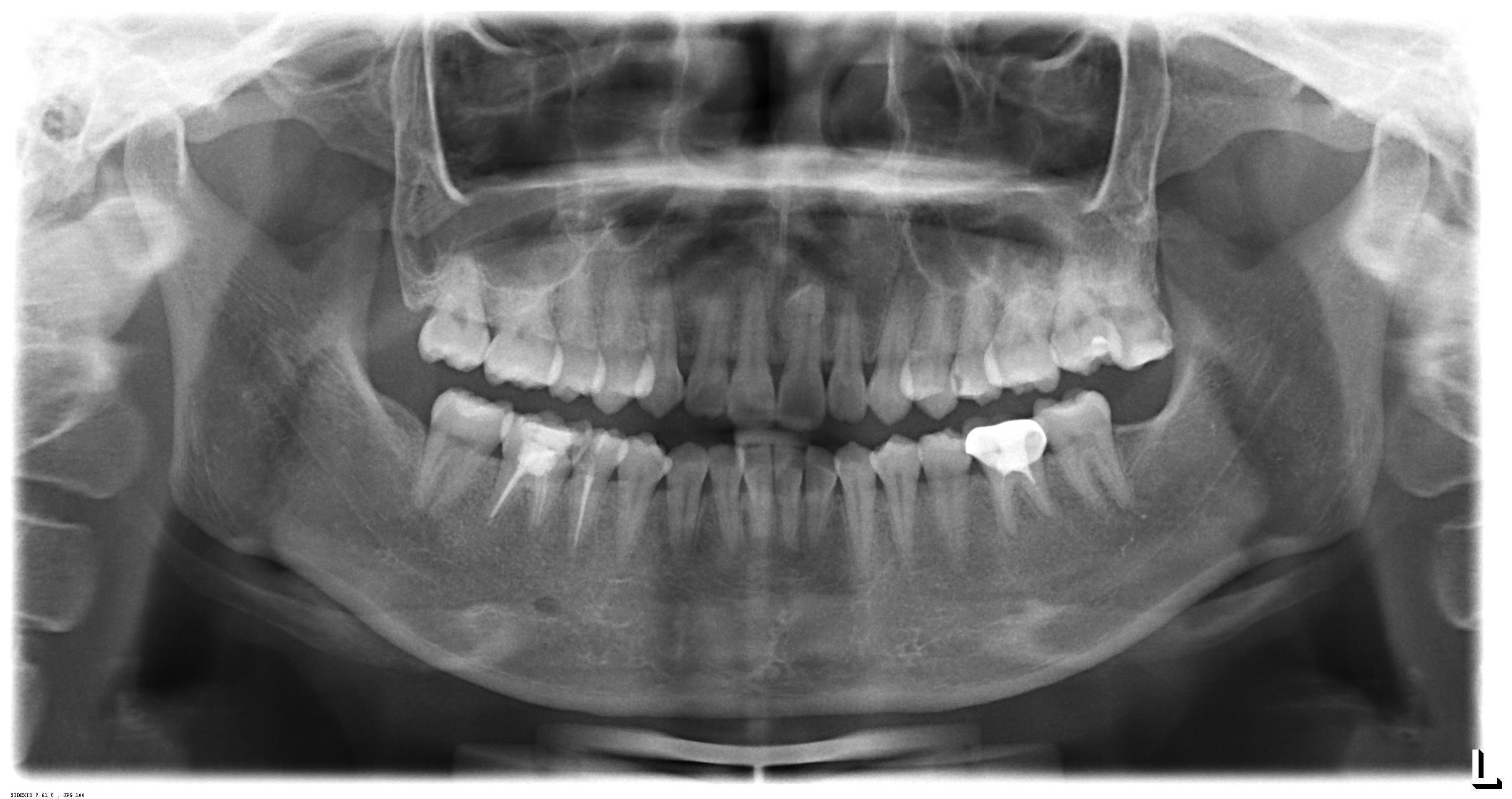 teeth-2 Instance Segmentation Dataset by Roboflow