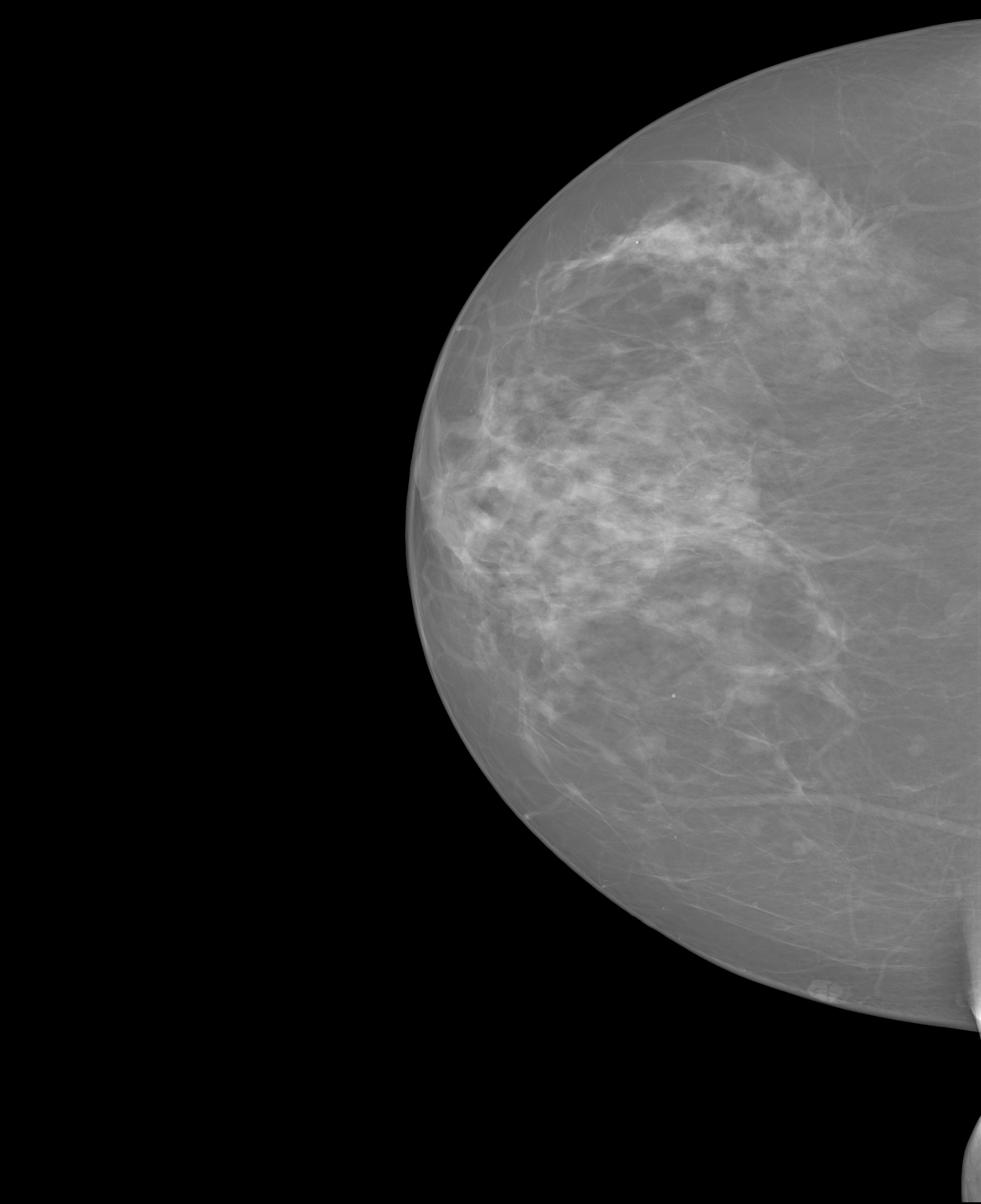 Detection Instance Segmentation Dataset By Breast