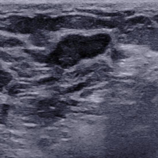 Ultrasound Instance Segmentation Dataset By Breast