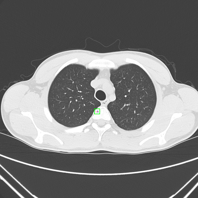 lung cancer demo 2 Object Detection Dataset by College