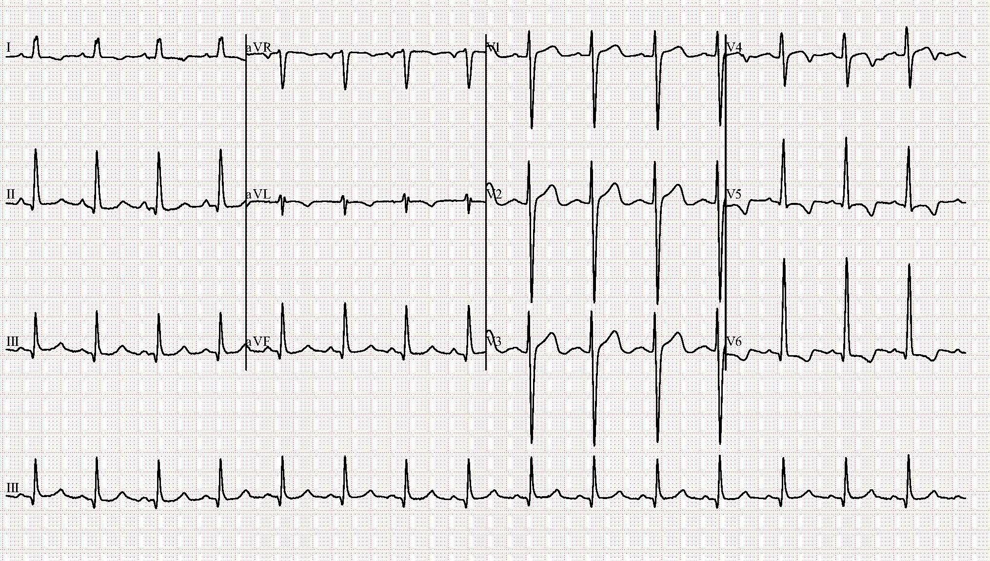 ecg Object Detection Dataset by annauniv