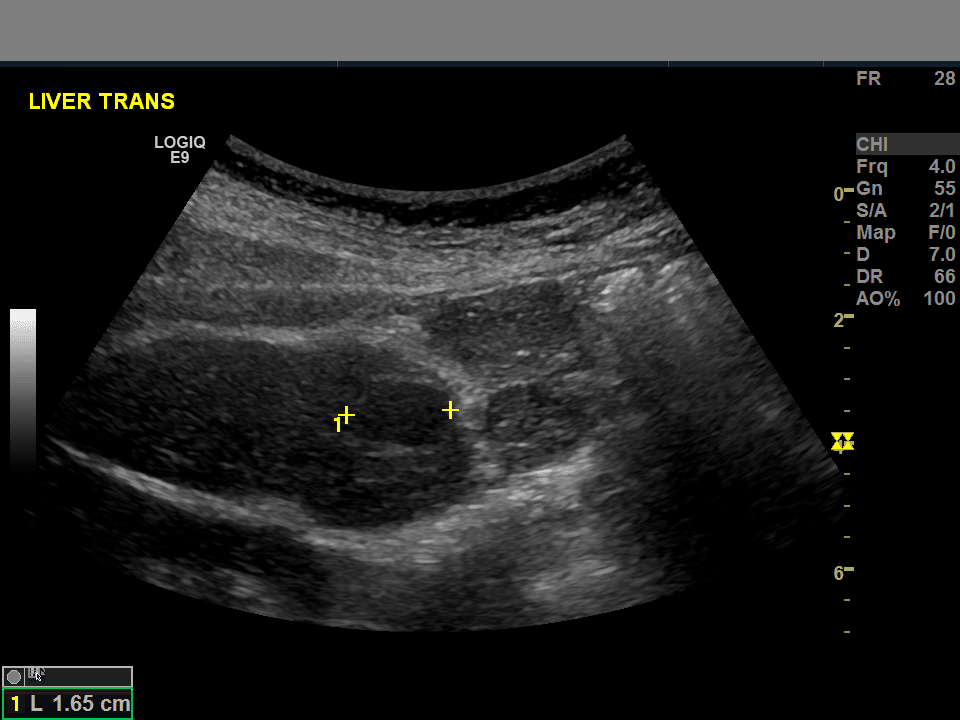 liverultrasound Instance Segmentation Model by ultrasoudn