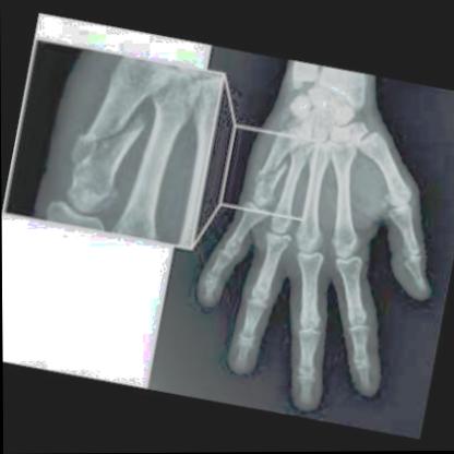 bonefracturedetection_v1 Object Detection Dataset and Pre-Trained Model by bonefracture