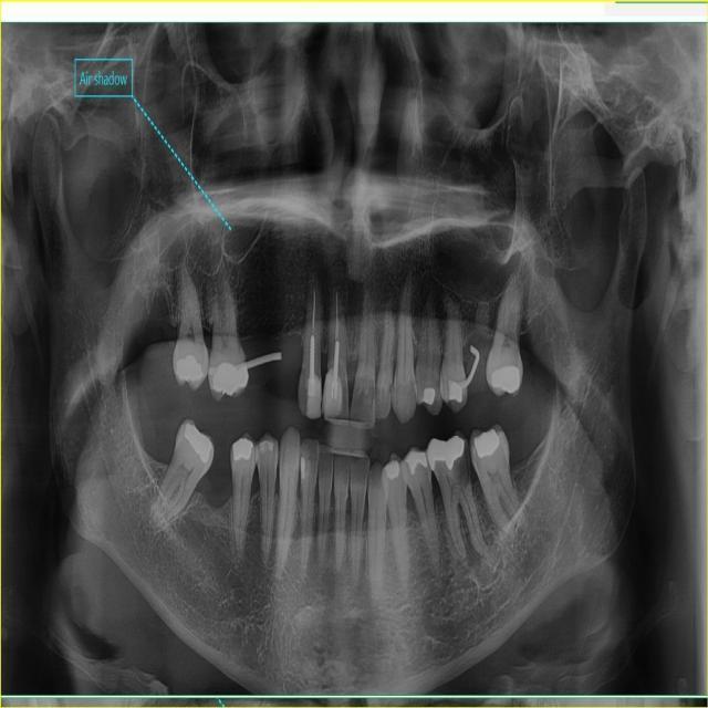 Caries Instance Segmentation Dataset V1 2024 07 31 4 03am By Caries