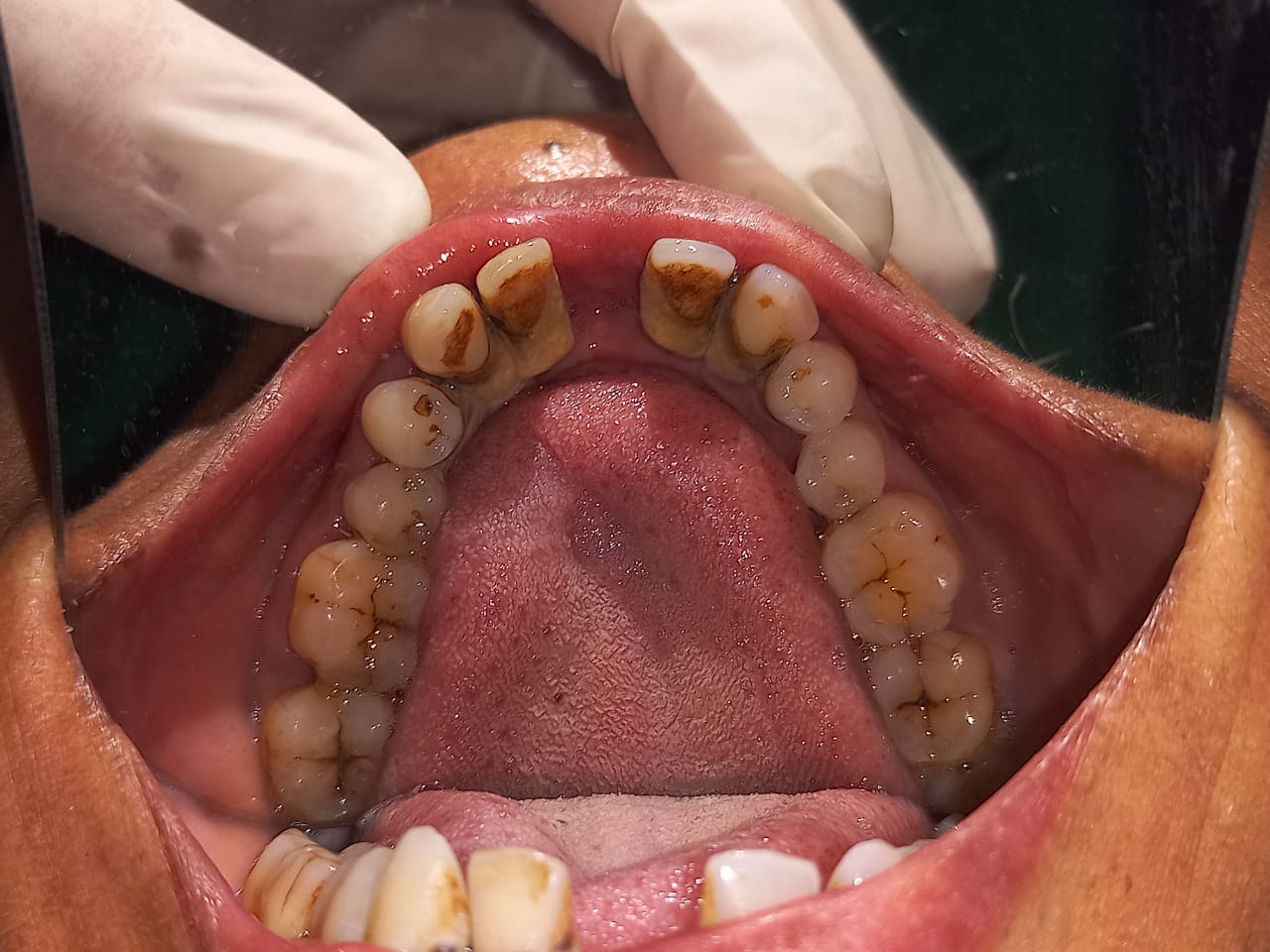 Caries Object Detection Model by BETiC