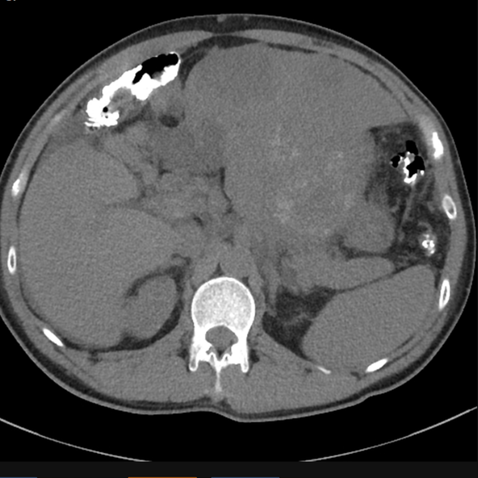 LiverScan V Instance Segmentation Dataset by Thesis