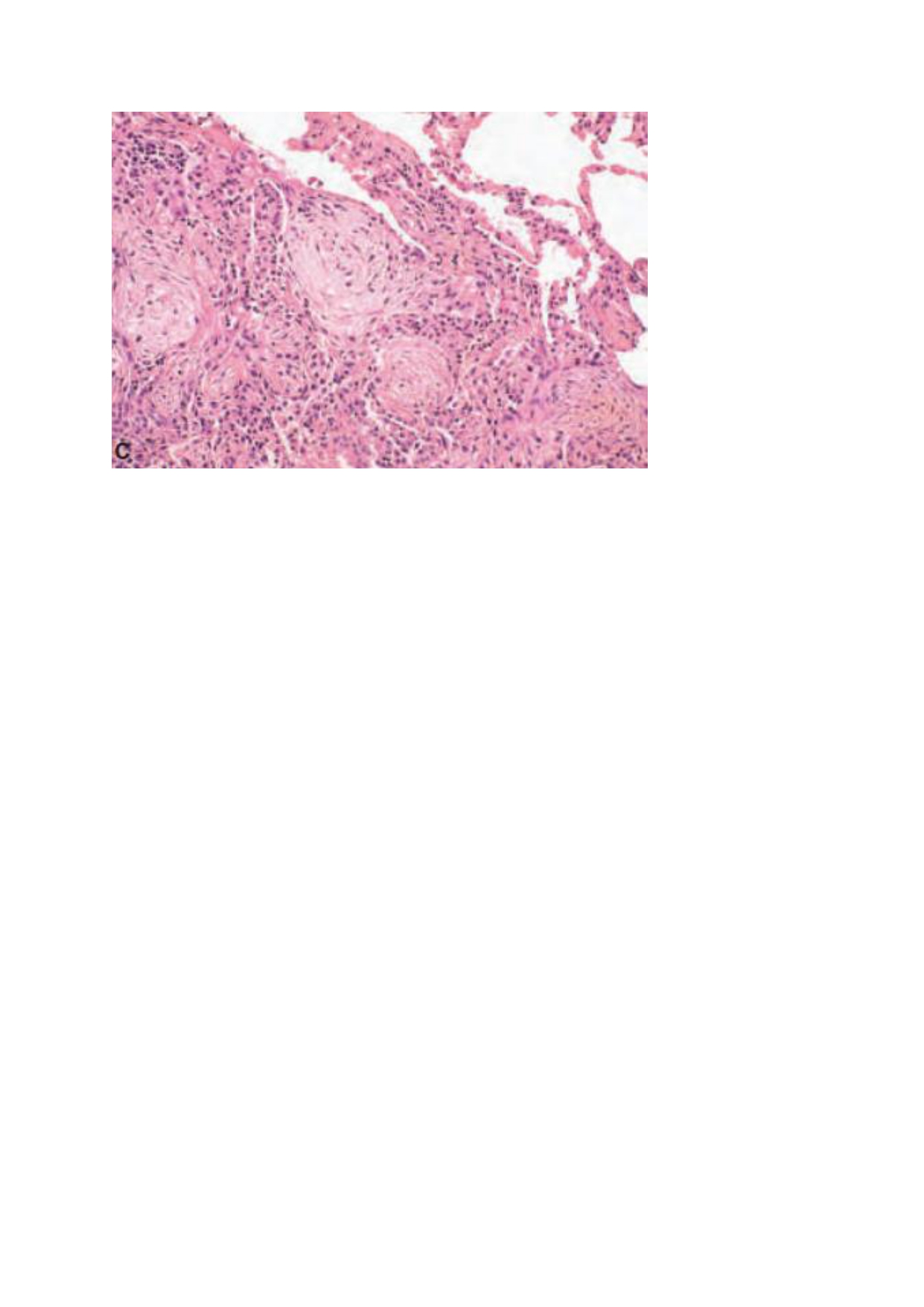 Pneumonia Detection Object Detection Dataset And Pre Trained Model By