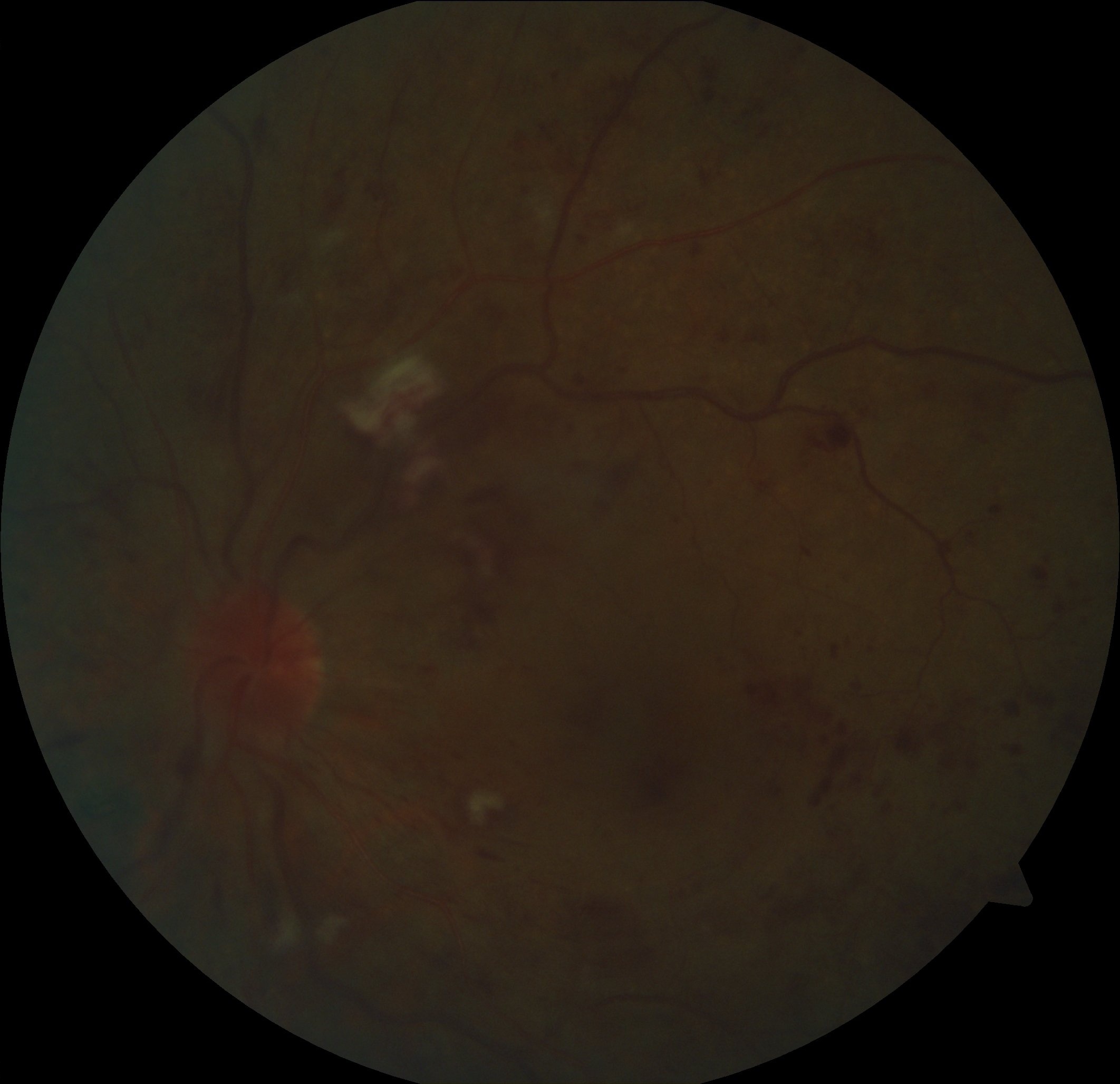 retina clot Classification Dataset by college