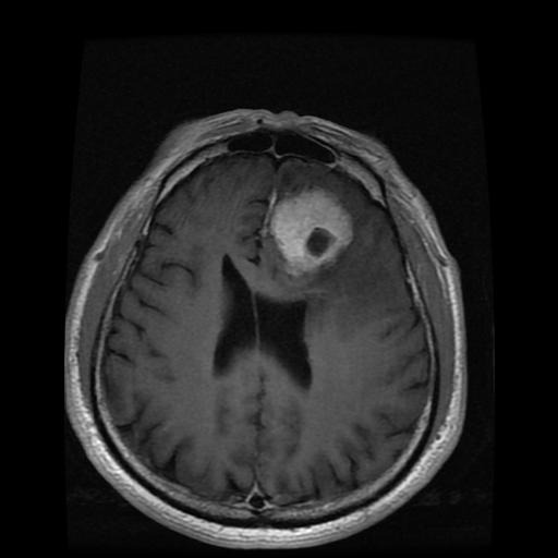 meningioma Instance Segmentation Dataset by MRI Image