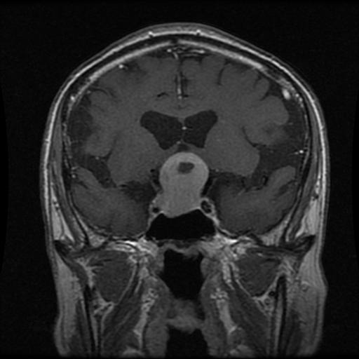 pituitary Instance Segmentation Dataset by MRI Image