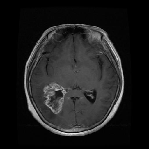 glioma Instance Segmentation Dataset by MRI Image