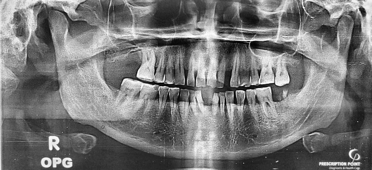dental xray Object Detection Dataset by ai projects