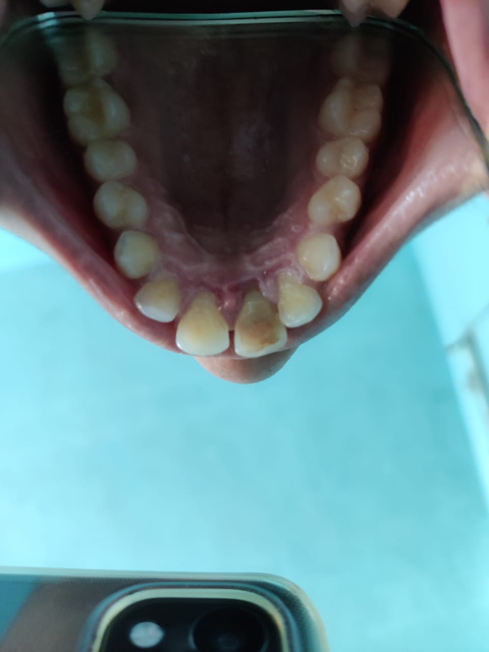 Dental Caries Demo Object Detection Dataset And Pre Trained Model By