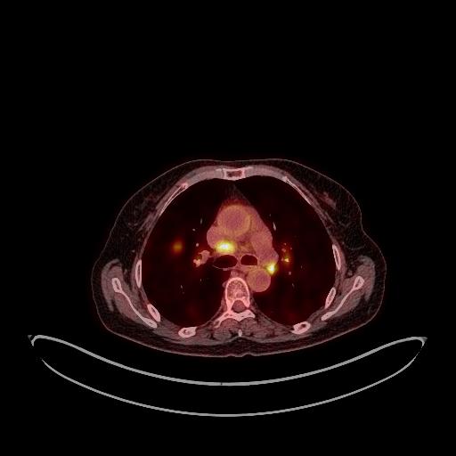 lung Nodule Object Detection Dataset by lung