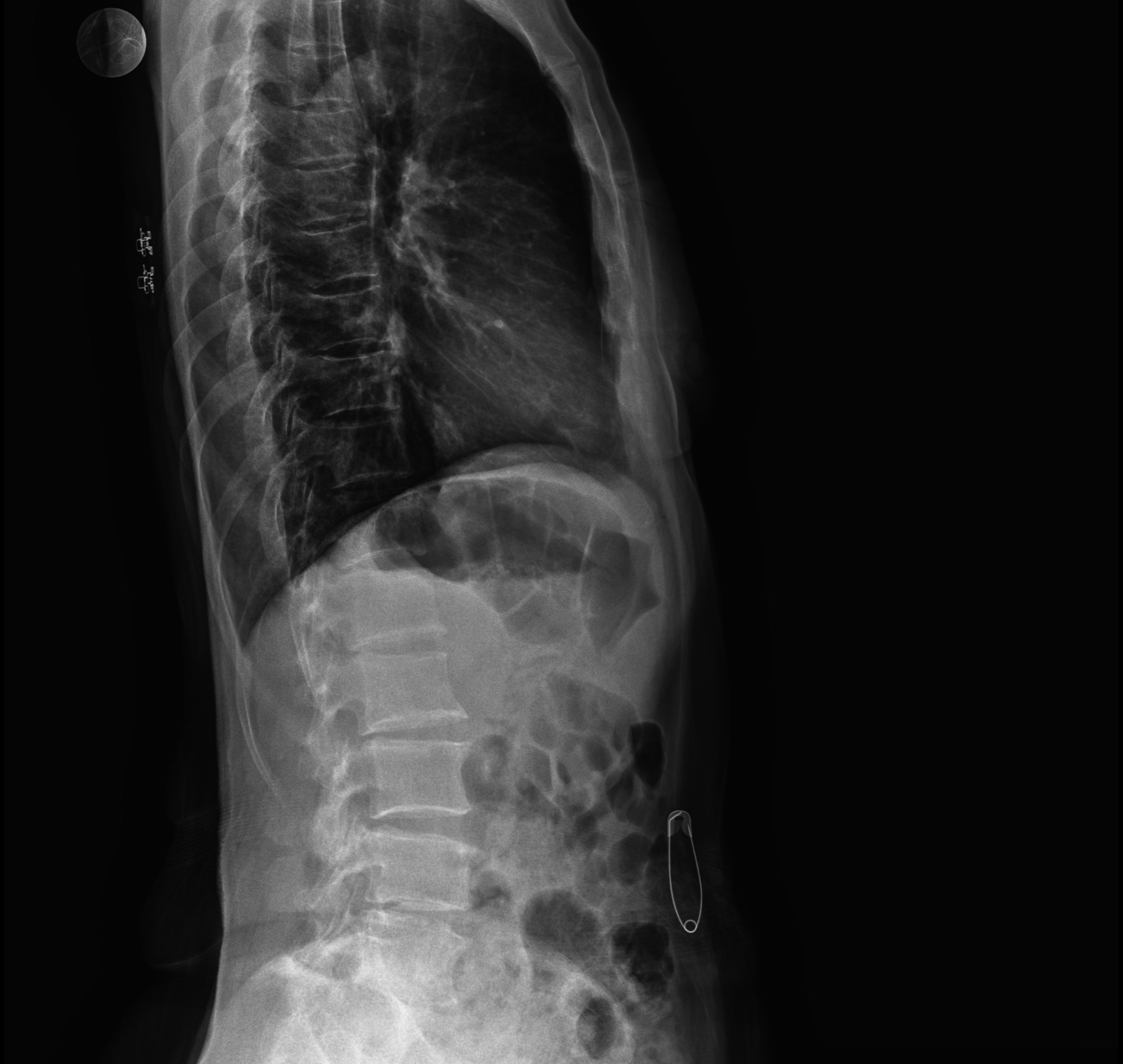 Lumbar Sponylolisthesis Object Detection Dataset and Pre-Trained Model by Logan Nye