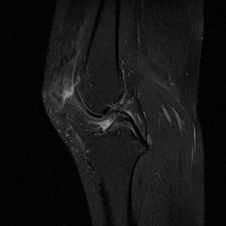 ACL injury severity classifier Object Detection Model by Omars Workspace