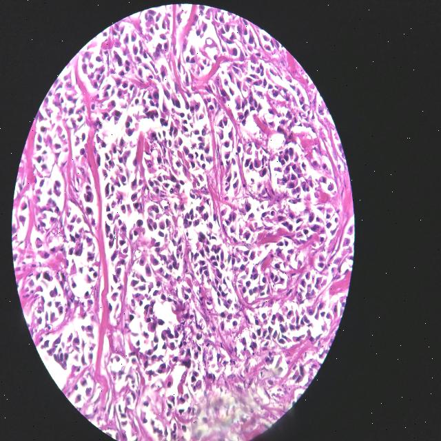 Cancer Object Detection Model by Anusha Shetty