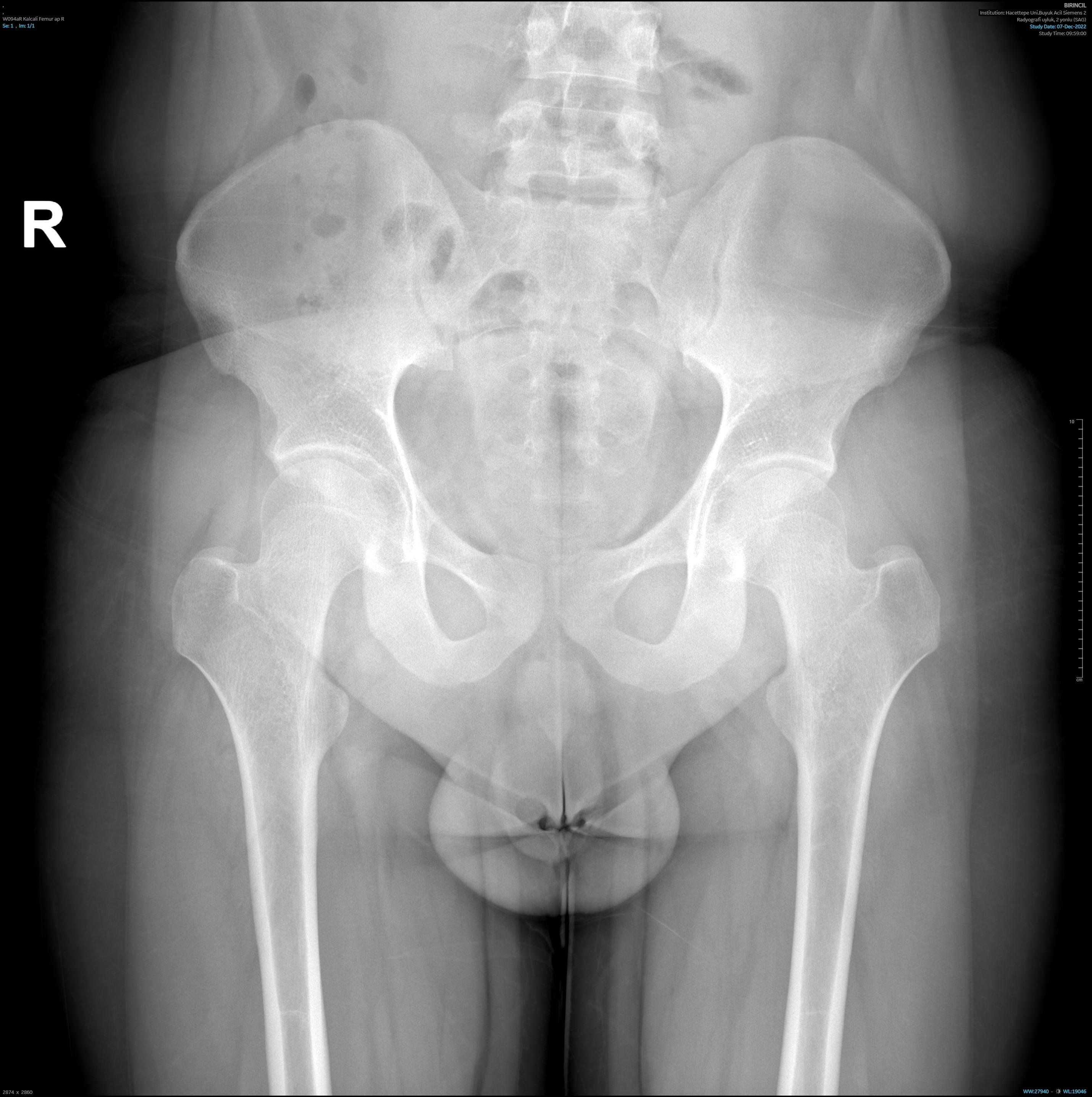 Pelvis Instance Segmentation Dataset by PBFS