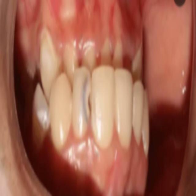 Cavity Detection Object Detection Dataset By Dental