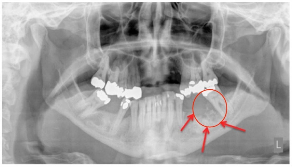 oralcancer Object Detection Dataset by dental