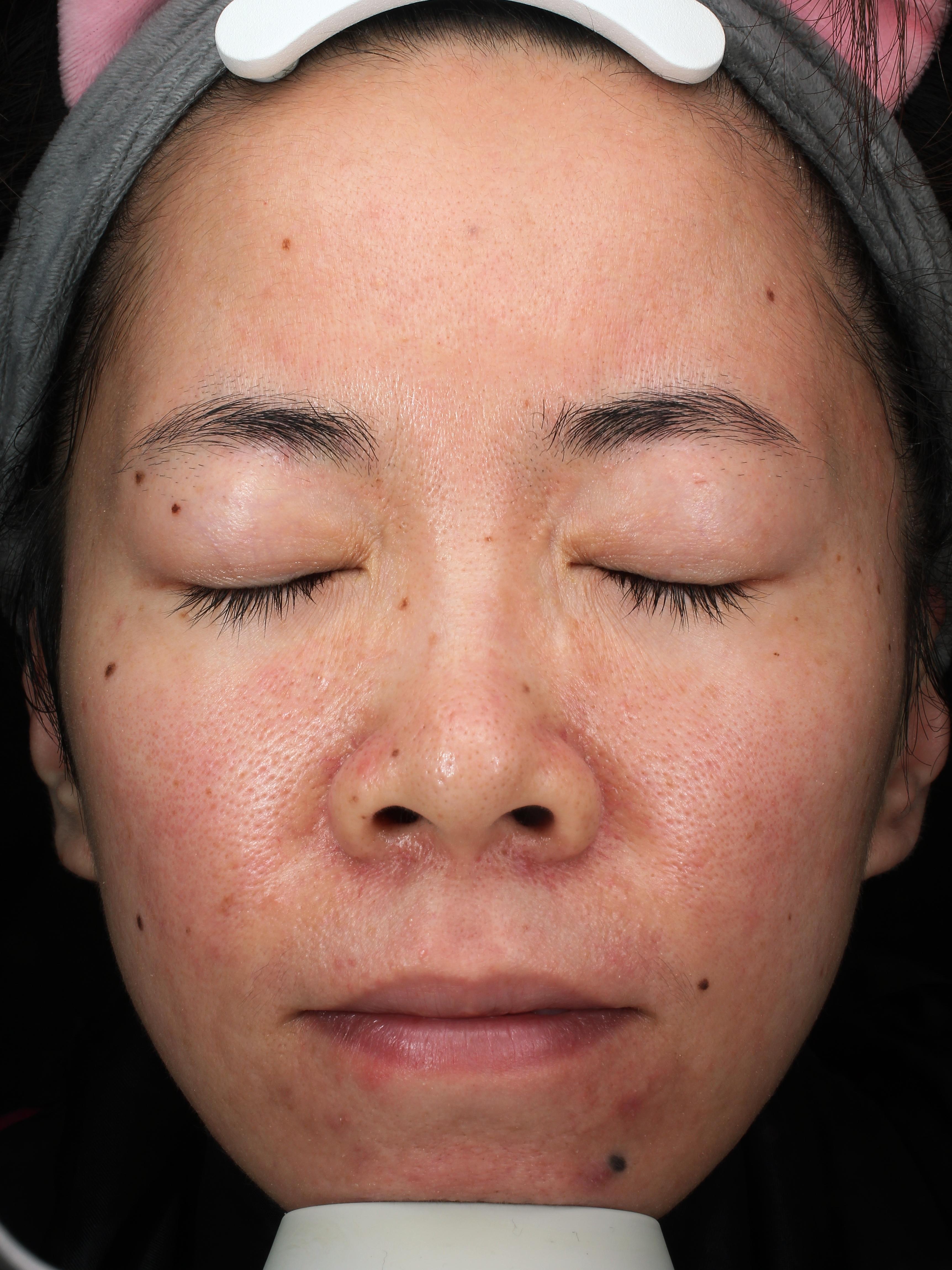 ACNEDETonly Object Detection Dataset by Detect