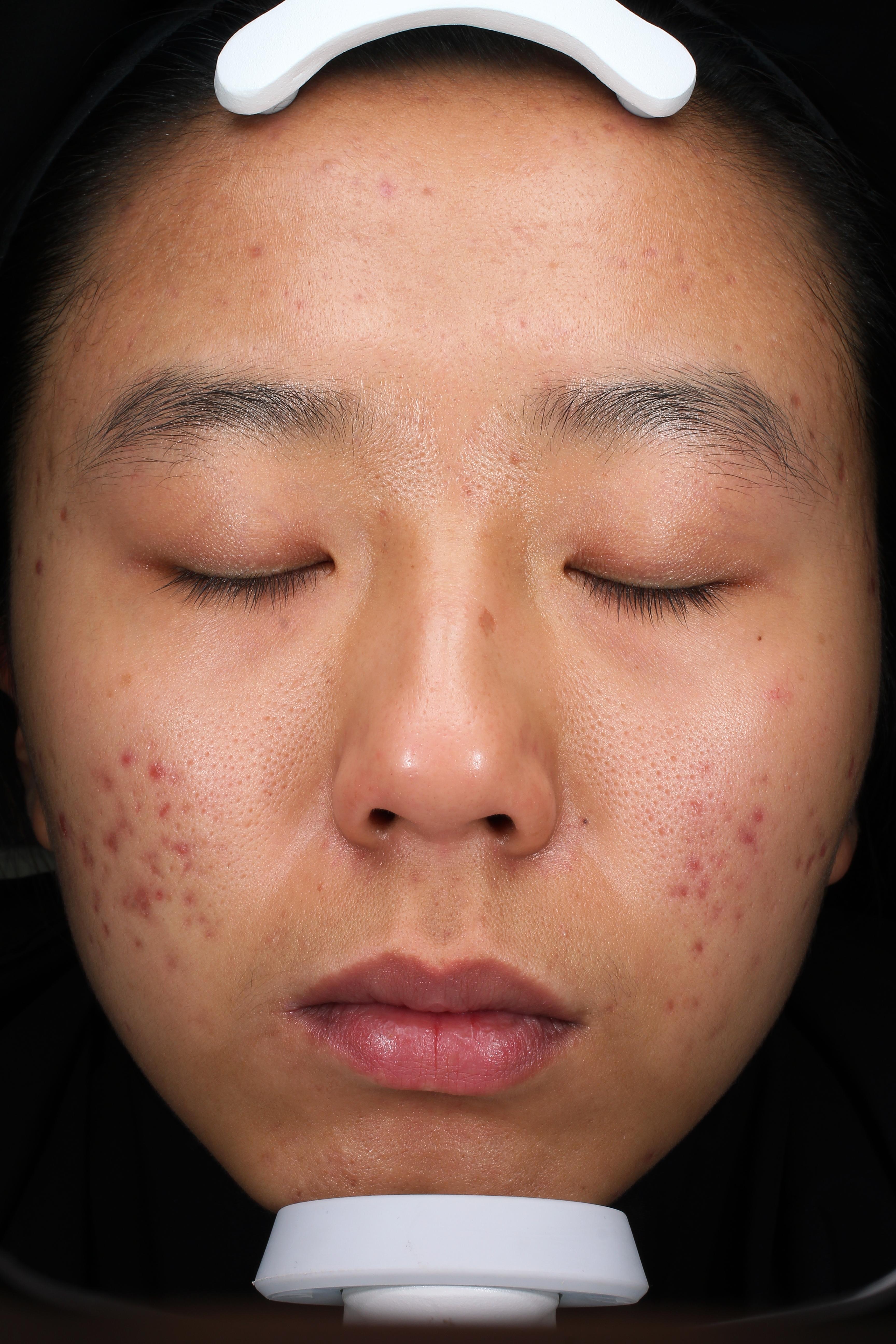 acnedet Object Detection Dataset by Detect