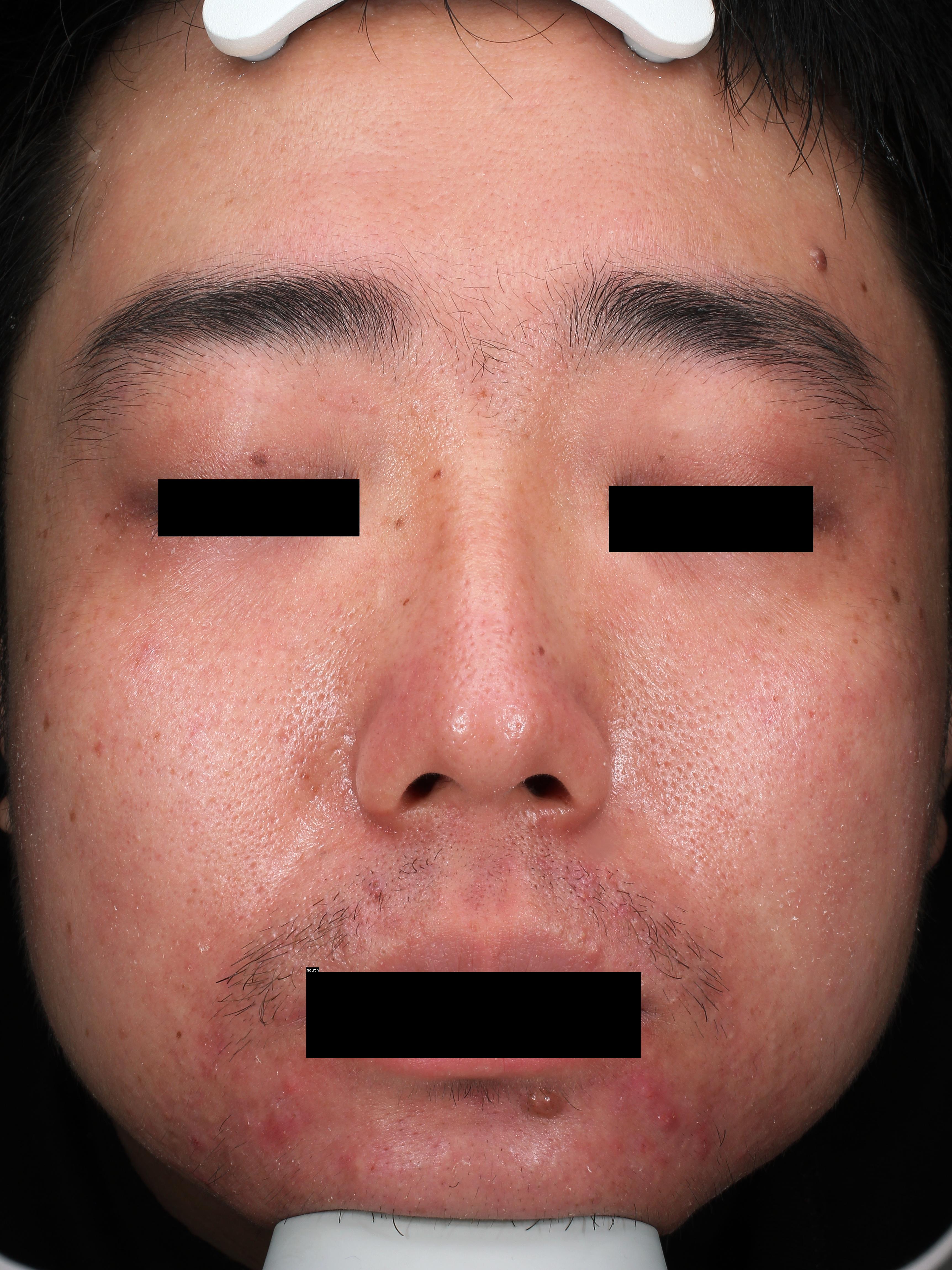 ACNESCU Object Detection Dataset by Detect