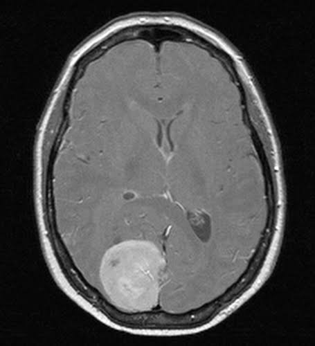 Brain Tumor Detection Object Detection Dataset And Pre Trained Model By