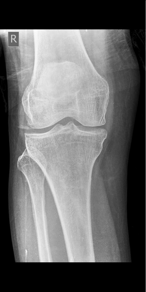 Osteo Demo Classification Dataset And Pre Trained Model By Akb 