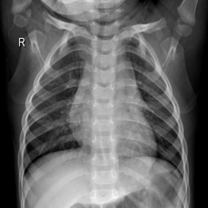 Pneumonia Detection Classification Dataset and Pre-Trained Model by ...