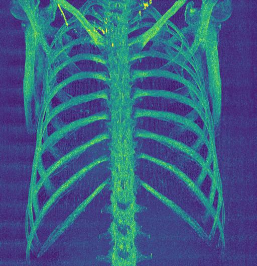 Vertebrae Object Detection Dataset and Pre-Trained Model by geisinger