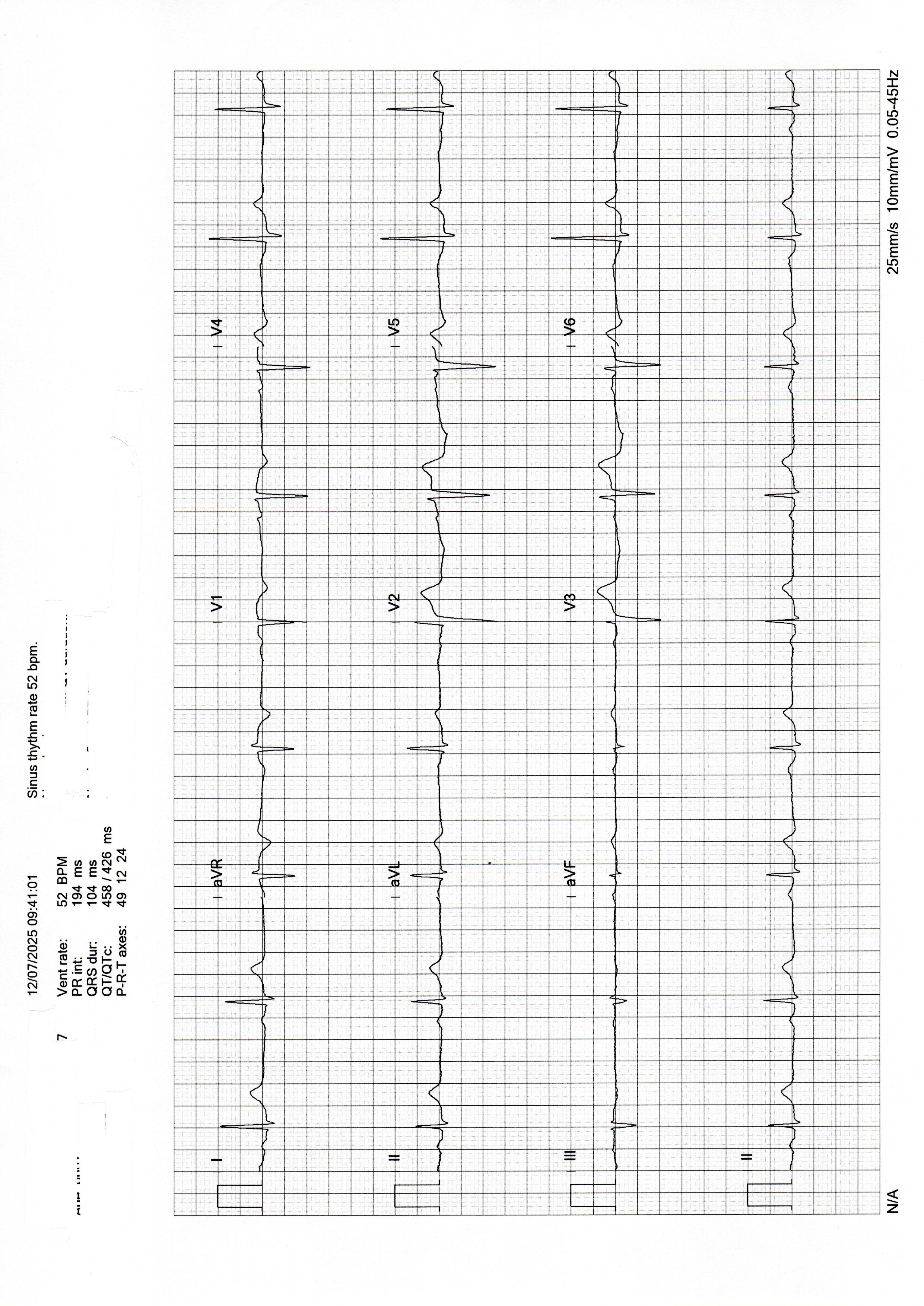 STEMI-Classifier-v1-1 Classification Dataset by AI Healthcare Workshop