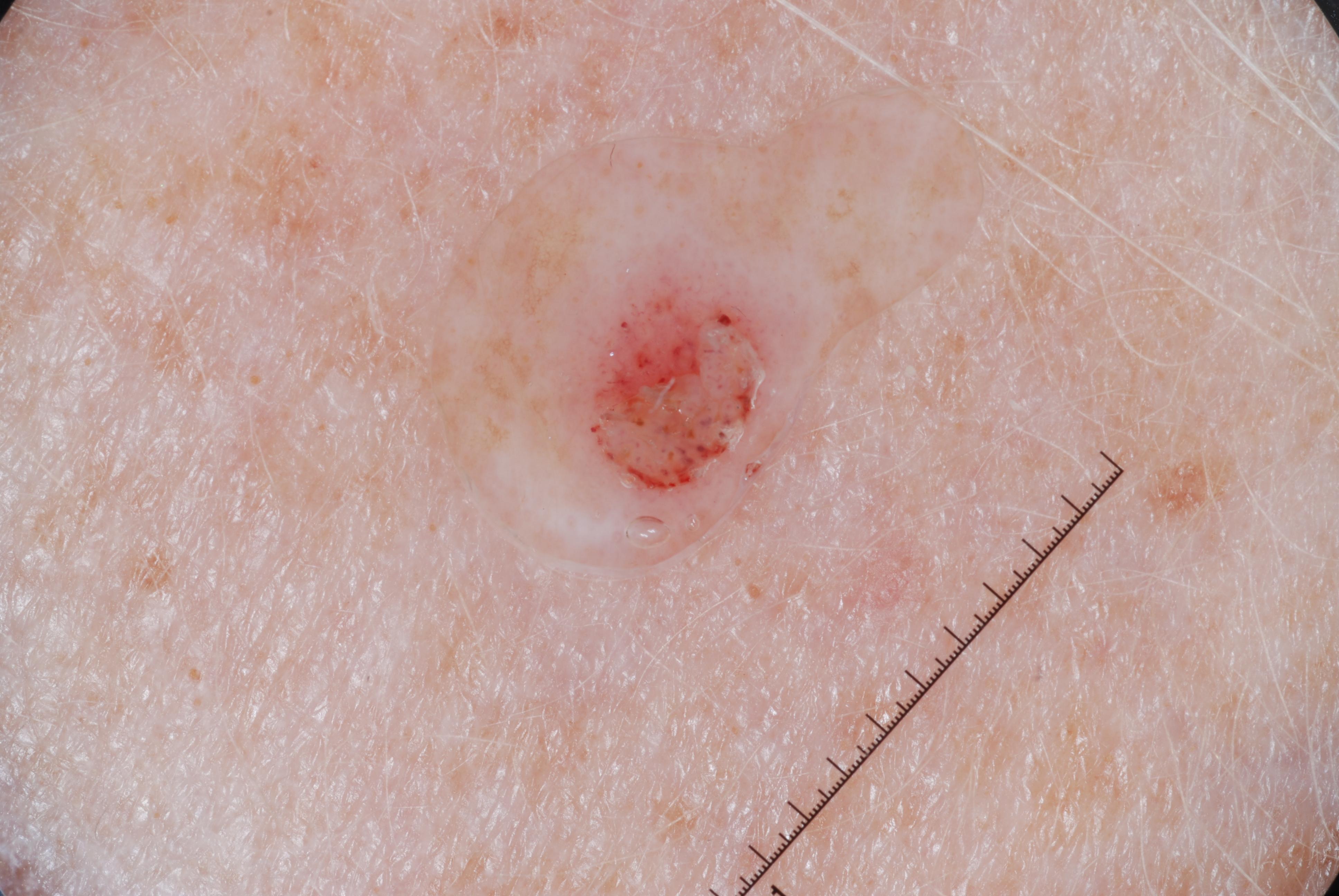 Thesis with early signs Classification Dataset and Pre-Trained Model by THESIS