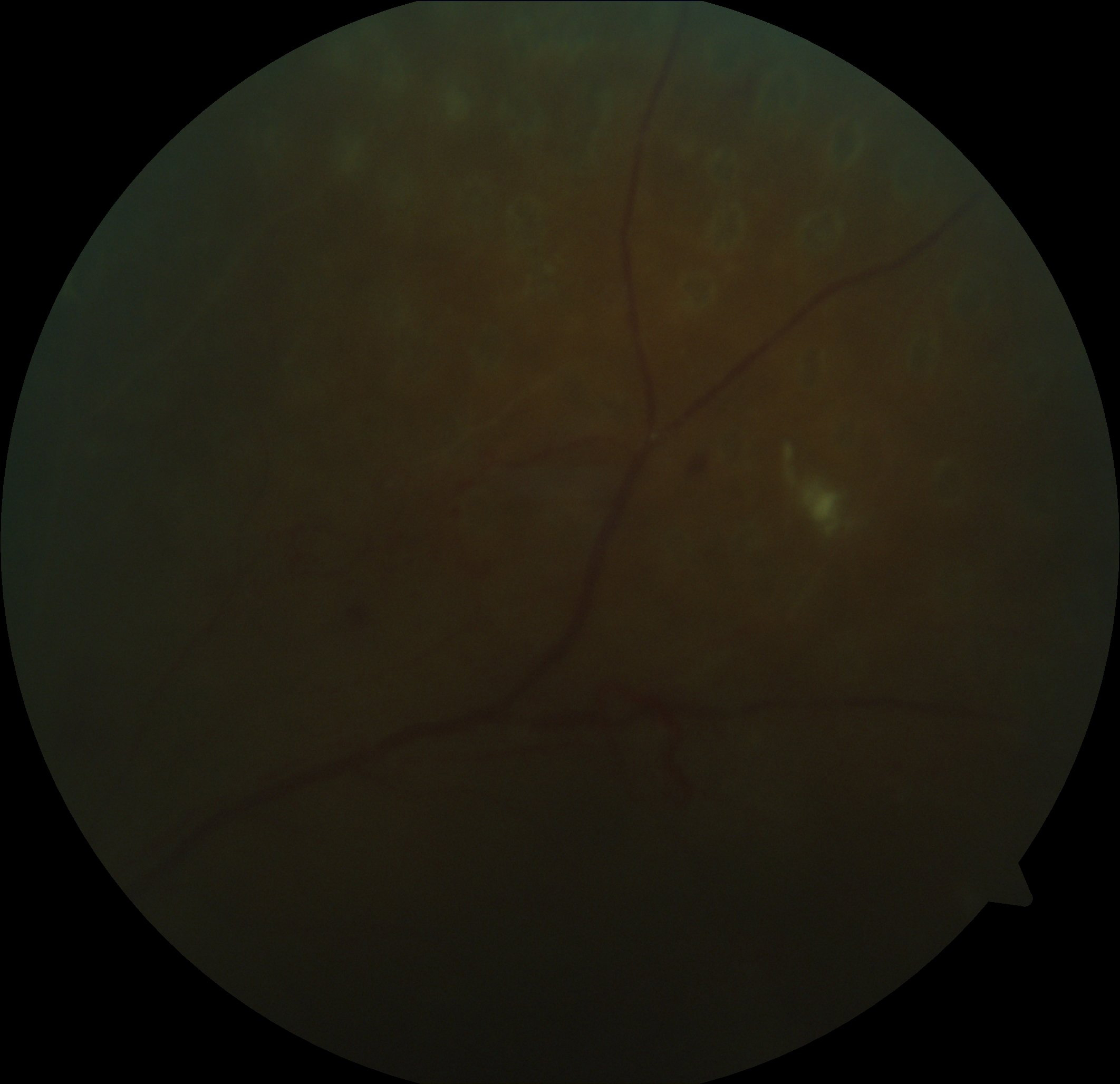 diabetic retinopathy detection Object Detection Dataset and Pre-Trained ... diabetic retinopathy detection Object Detection Dataset and Pre-Trained ...
