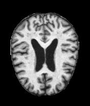 Alzheimer-MRI-Classification Classification Dataset by NeuroBiotics
