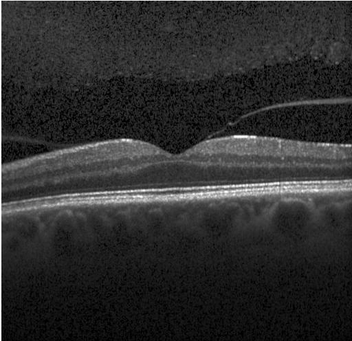 OCT-Retina Classification Dataset by Grnt ileme