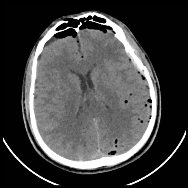 Stroke Object Detection Model by Stroke