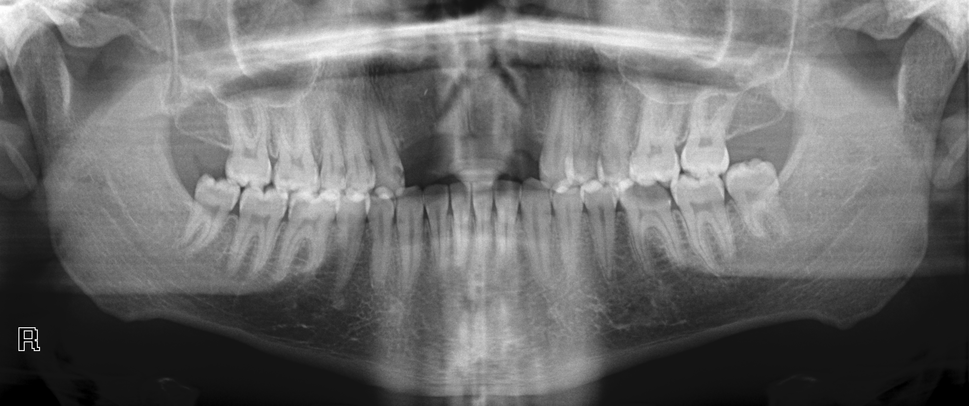 Caries Detection Instance Segmentation Dataset By Laya Room