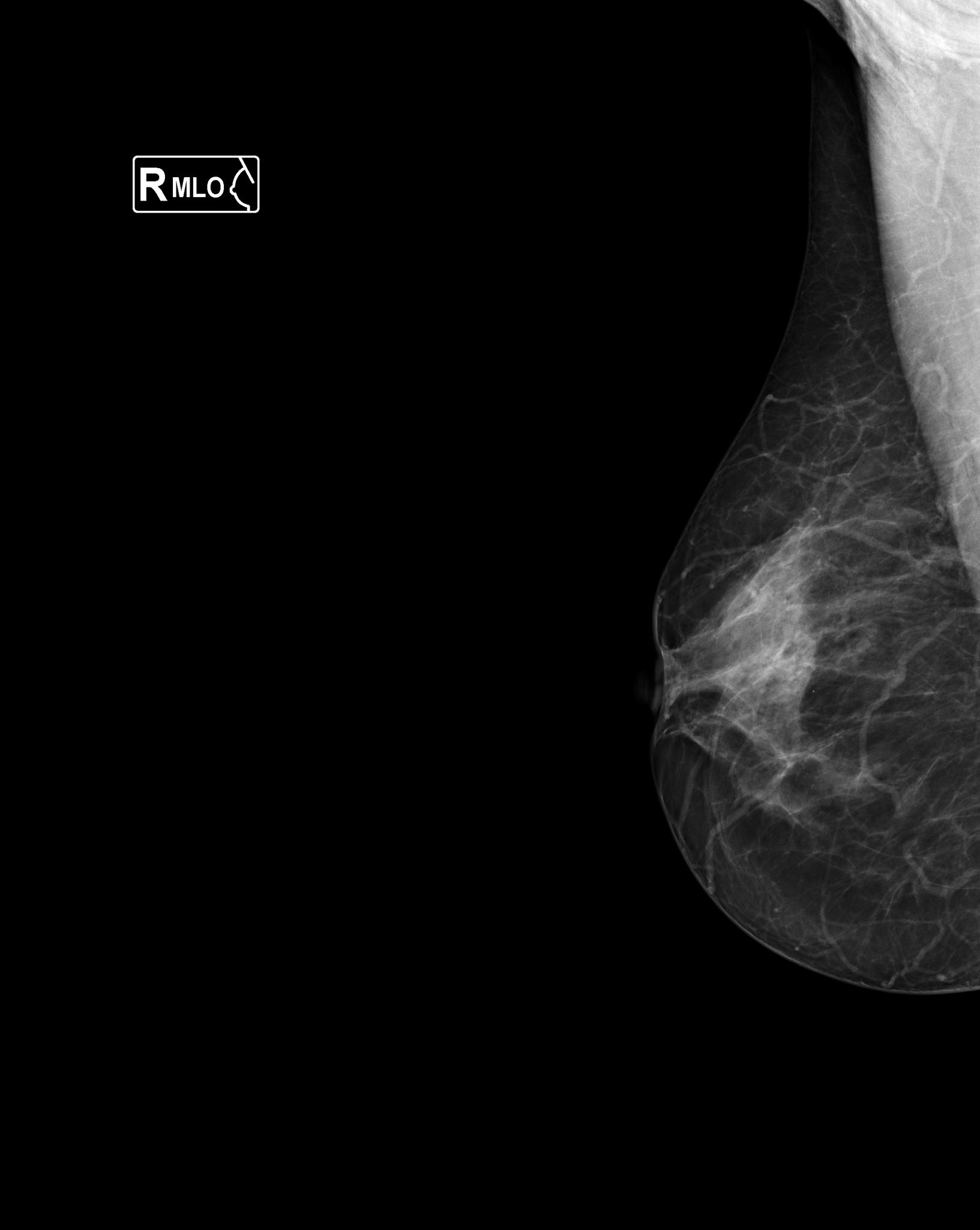 Breast Segmentation Instance Segmentation Dataset And Pre Trained Model