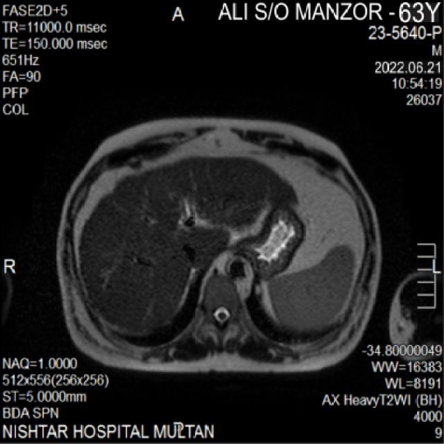 LNV Object Detection Dataset by LIVER TUMOR DATASET