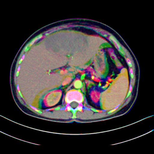 Liver Instance Segmentation Dataset by LIVER TUMOR DATASET