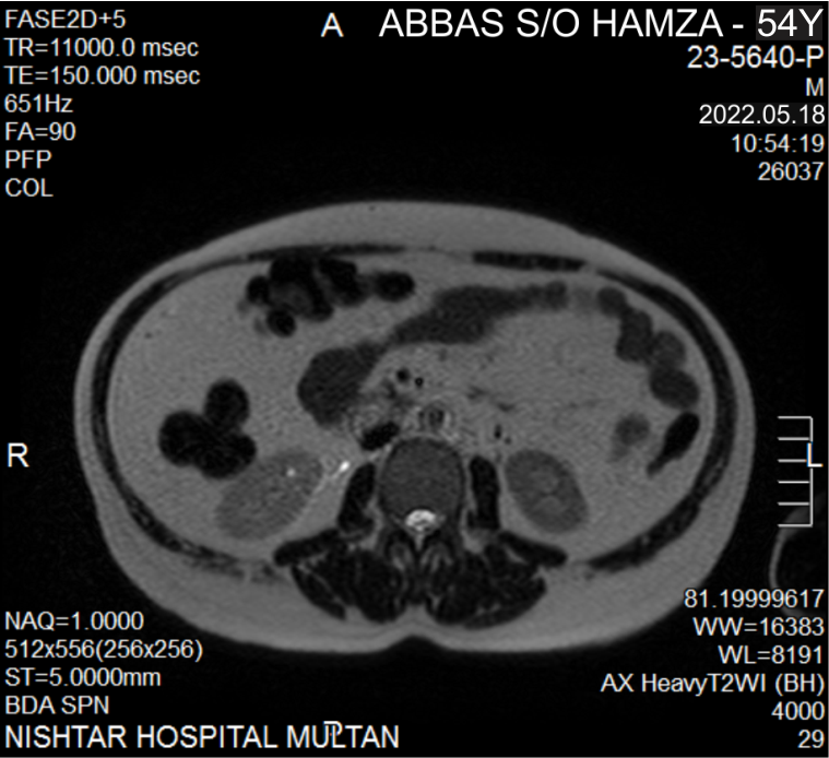liver tumor detection Object Detection Dataset by LIVER TUMOR DATASET