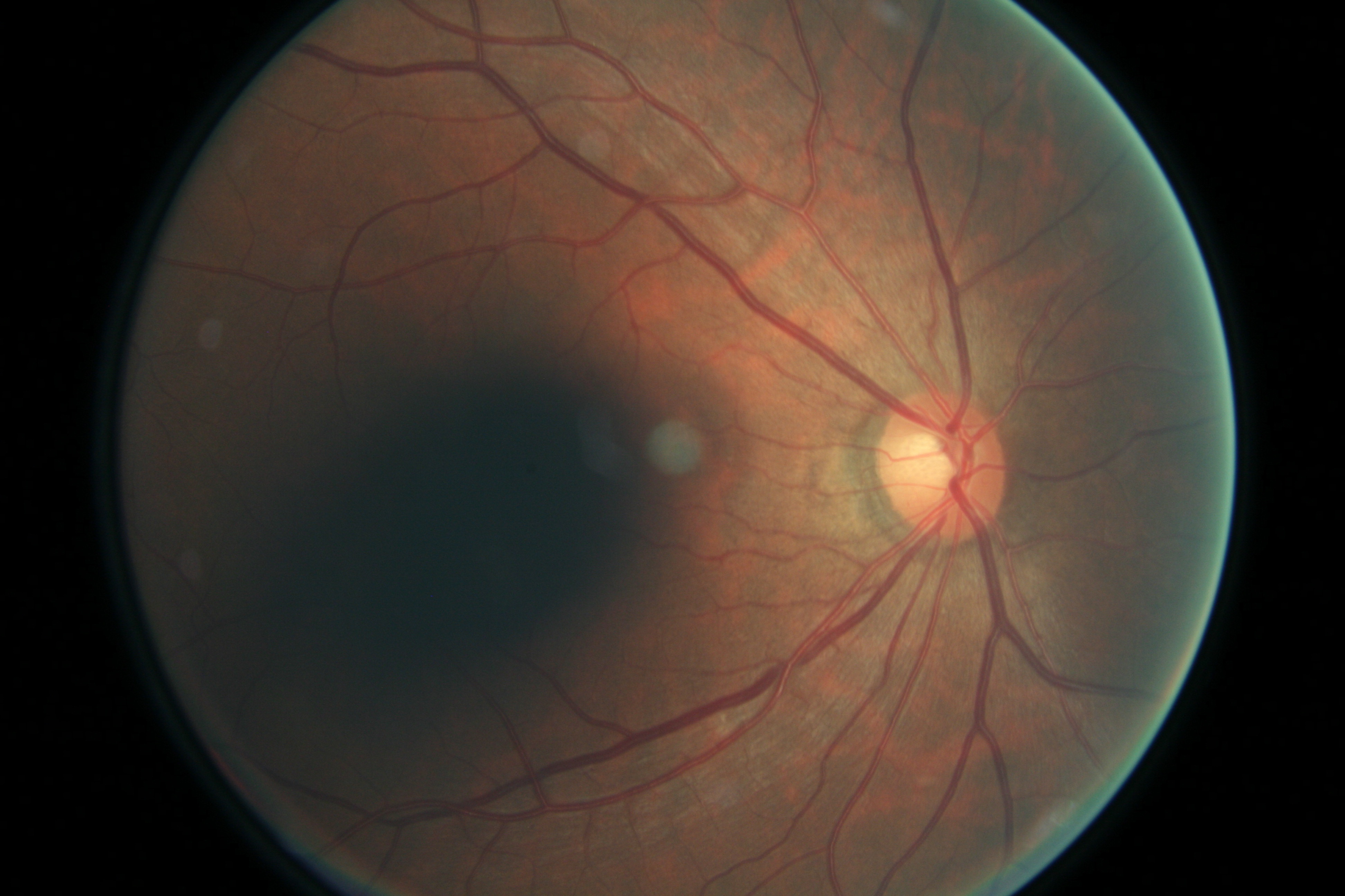 eyes Classification Dataset by Final Lab