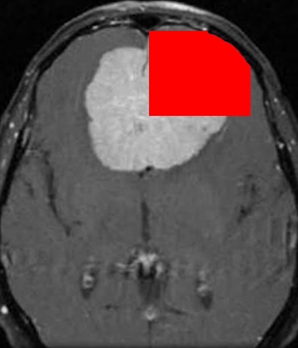 Brain Detection Object Detection Dataset And Pre Trained Model By Brain