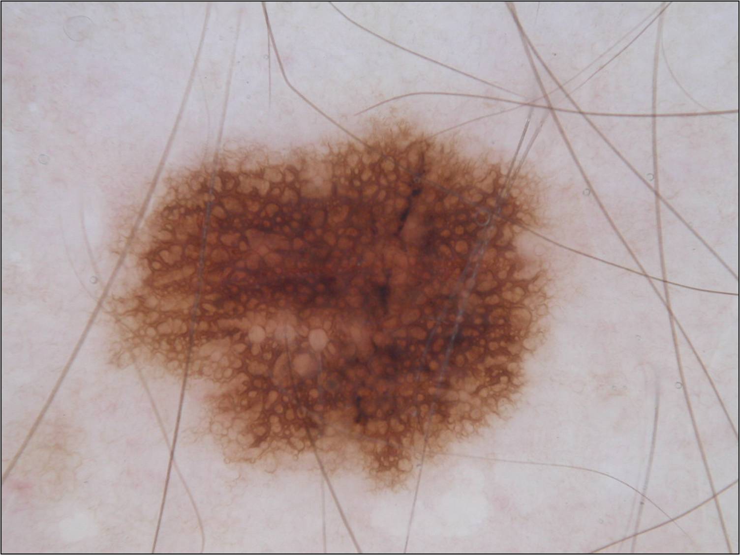 Skin-Disease Object Detection Model by LUMS