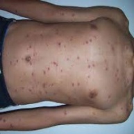 Skin Disease Classification Classification Dataset by Capstone