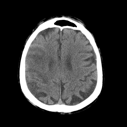 Stroke Fi̇nal Classification Model By Hashem
