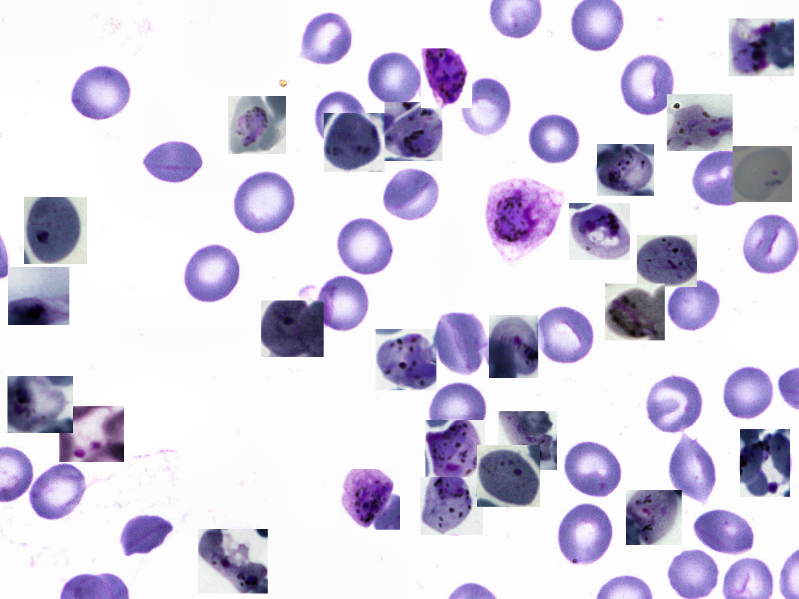 malaria Object Detection Dataset by TFG