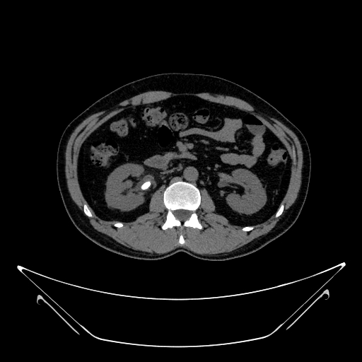 Annotation of Renal stone Instance Segmentation Dataset by CUJ